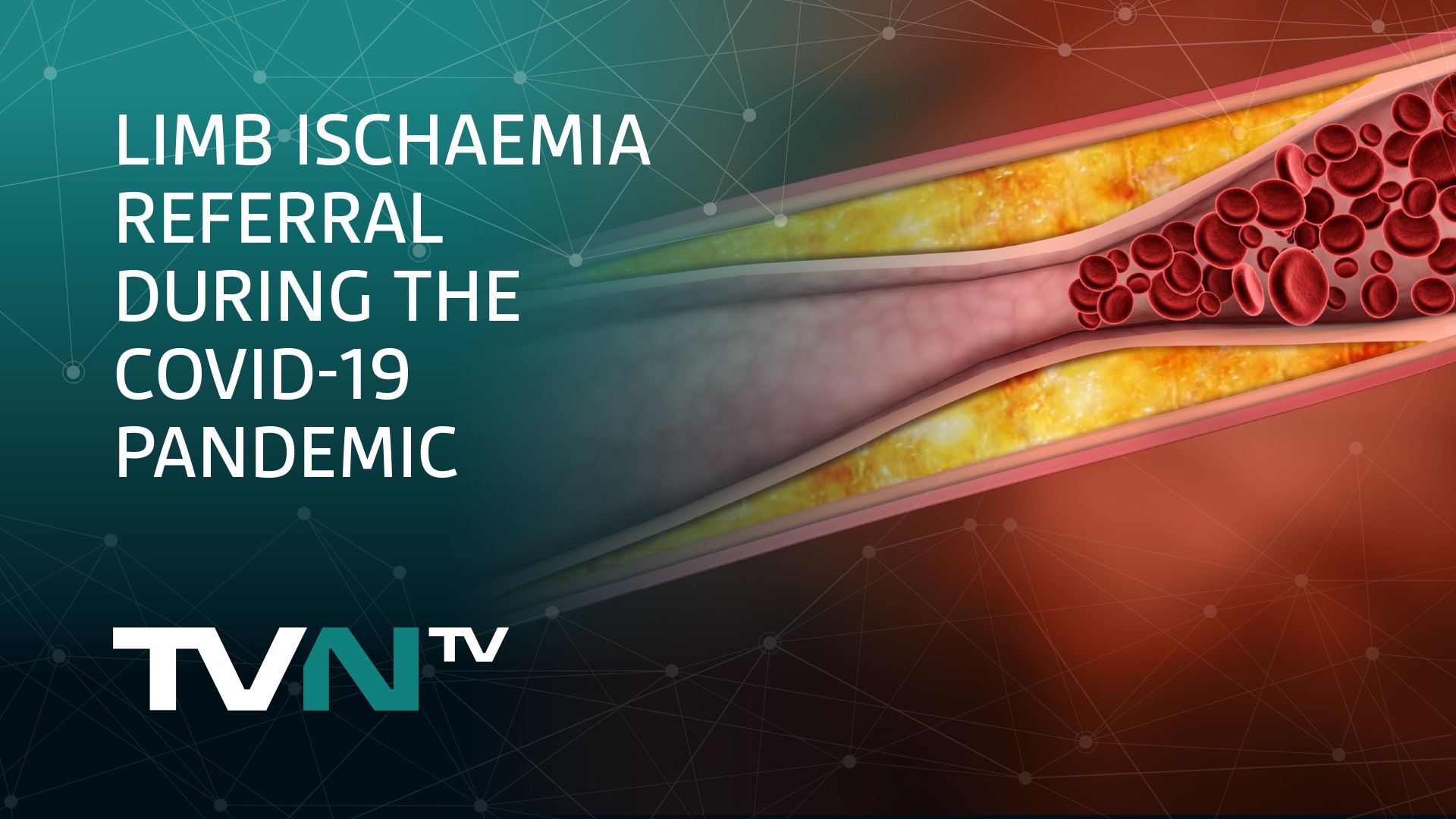 LIMB ISCHAEMIA REFERRAL DURING THE COVID-19 PANDEMIC - TVN-TV
